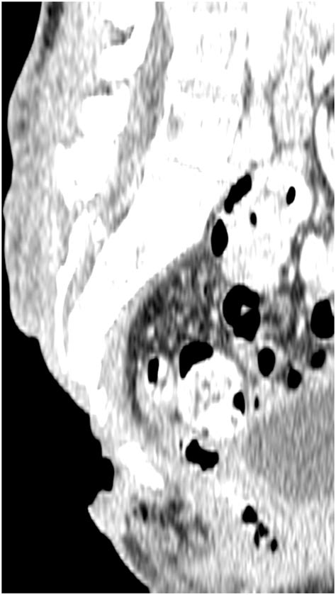 Preoperative Computed Tomography Scan Showing The Three Dimensional