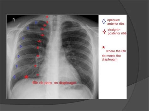 Cxr Imaging