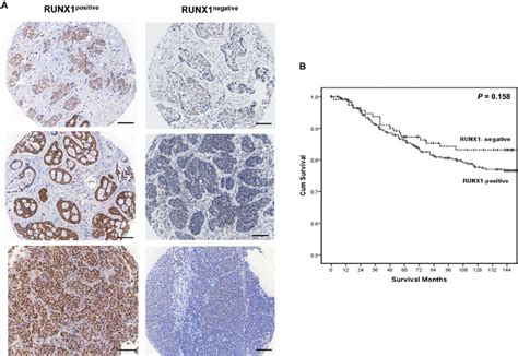 Runx1 Expression And Cancer Specific Survival In Primary Operable Download Scientific Diagram