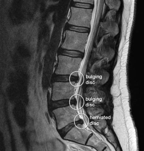 Spine Bulging Disk Xray Morninglokasin