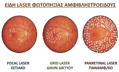 Focal Laser Photocoagulation Focal Laser Implications And Procedural