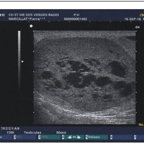 Ultrasonography Of The Tumor Mass In The Left Testis Download