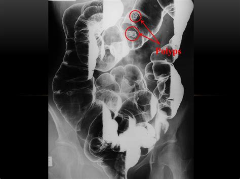What Is A Hepatic Flexure Colon Polyp At James Jain Blog