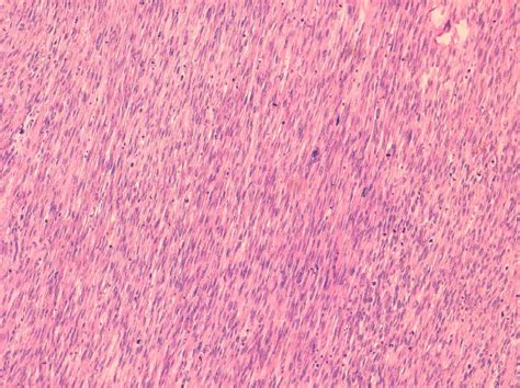 Tumoral Proliferation Composed Of Fascicles Of Spindle Cells
