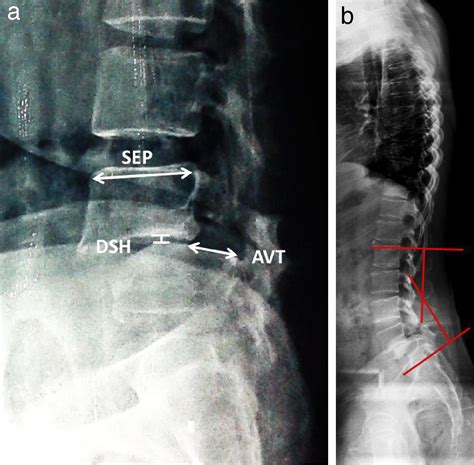 Transforaminal Lumbar Interbody Fusion With Local Bone Graft Alone For Single Level Isthmic