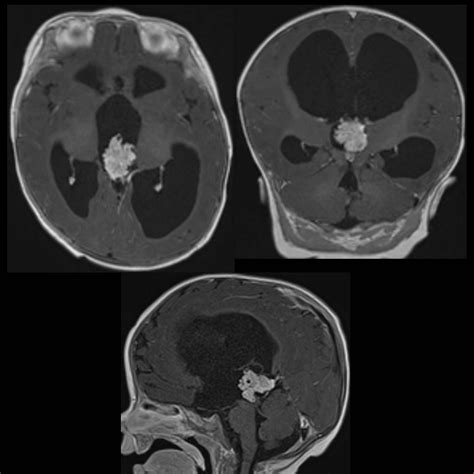 Pediatric Choroid Plexus Papilloma Pediatric Radiology Reference Article Pediatric Imaging