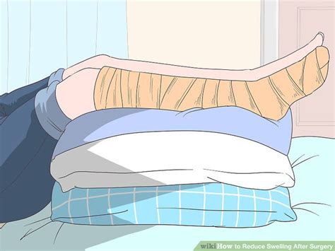 3 Ways To Reduce Swelling After Surgery Wikihow