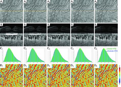 Attenuation Correction Eliminates The Effects Of Choroidal