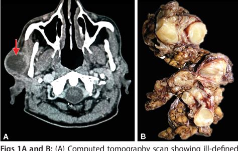 Figure 1 From Facial Plexiform Neurofibroma As An Intraparotid Nodule A Rare Case Presentation