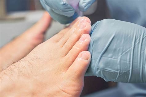 What To Know About Onycholysis Nail Separation