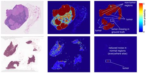 Assisting Pathologists In Detecting Cancer With Deep Learning
