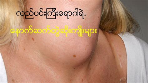 လည်ပင်းကြီးရောဂါကို ဖြစ်စေသော အကြောင်းအရင်းများ Youtube