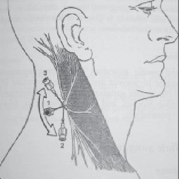 Deep Cervical Plexus Block Surface Marking For Cervical Vertebrae Download Scientific Diagram