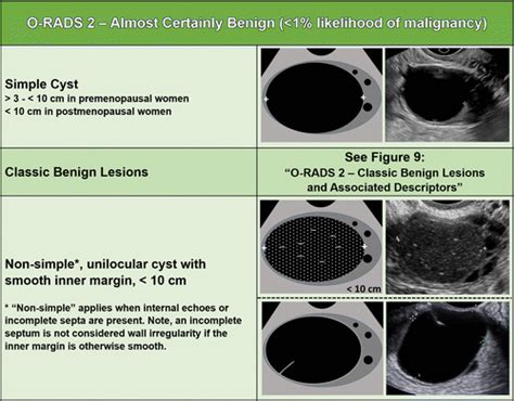 O Rads Us Risk Stratification And Management System A Consensus Guideline From The Acr Ovarian