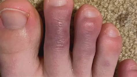 Why Are My Feet Itchy Our Top Tips For Itchy Toes And Feet My Footdr Atelier Yuwaciaojp
