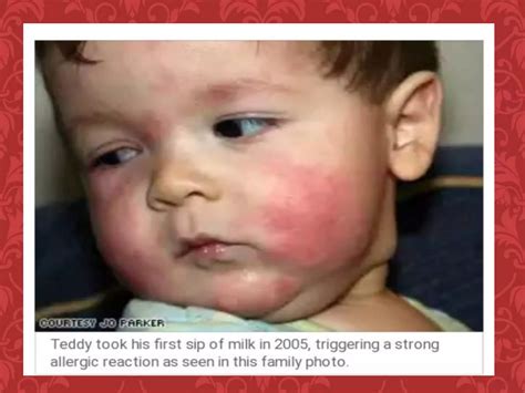 Hypersensitivity And Its Types Type 1 Anaphylaxis Type 2 Type 3 Type 4 Pptx Allergies