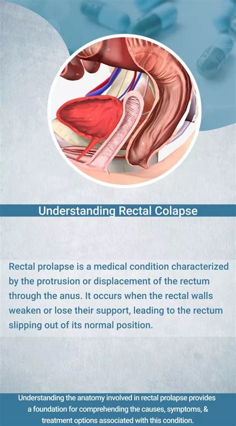 Ppt Rectal Prolapse Symptoms Causes Diagnosing Treatment