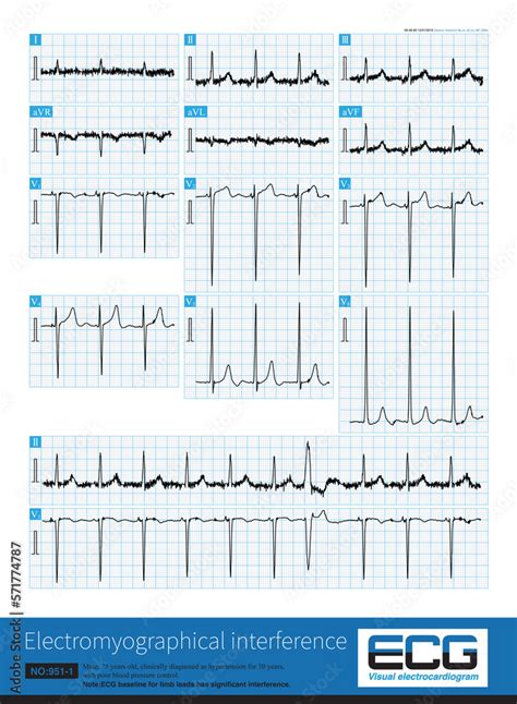 When The Baseline Of Ecg Is Interfered By Its Own Or External