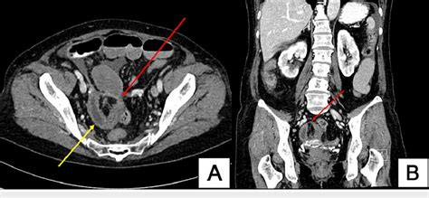 A Axial Ct Pelvis Showing U Shaped Closed Small Bowel Loop Yellow Download Scientific