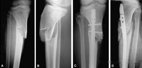 News Surgical Skills “percutaneous Screw” Temporary Fixation Technique For Proximal Tibia