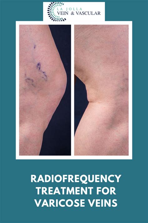 Radiofrequency For Varicose Veins