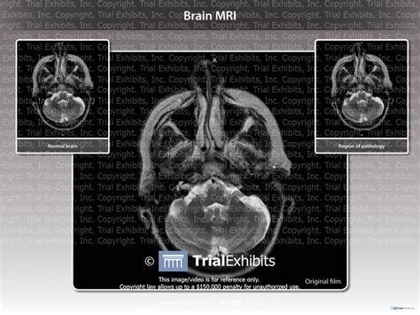 Brain Mri Normal Brain Vs Region Of Pathology Trialquest Inc