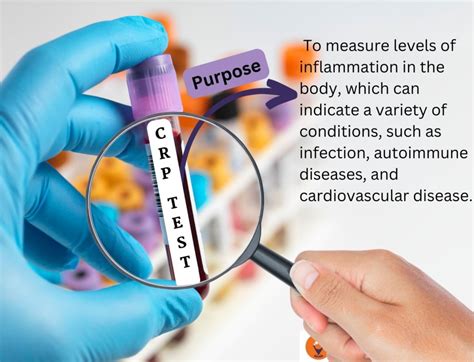 Crp Test Price Purpose Procedure Report And Normal Range
