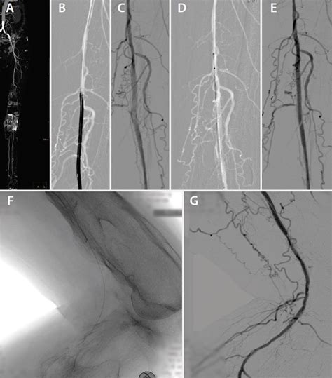 Taking On Complex Sfa Disease Endovascular Today