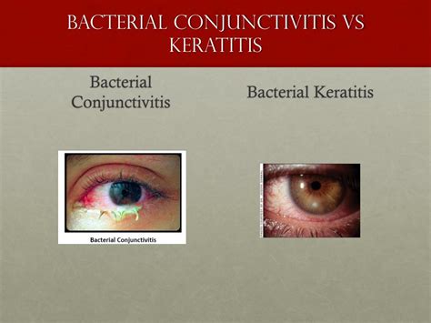 Uveitis Vs Conjunctivitis