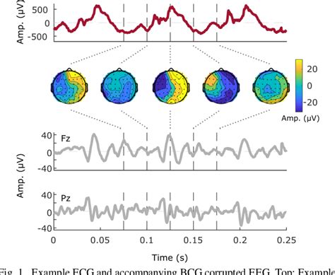 Figure 1 From Ballistocardiogram Artifact Reduction In Simultaneous Eeg Fmri Using Deep Learning