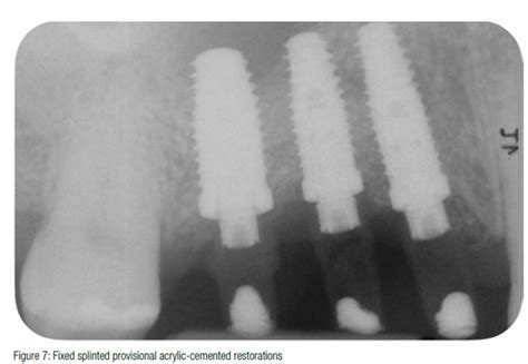Implantology News The Use Of Dynamic Navigation To Prevent Implant Complications Every