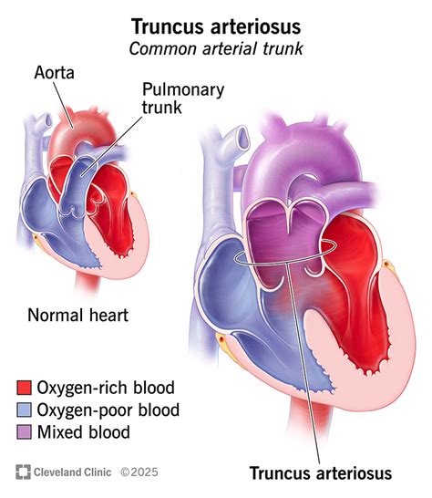 Truncus Arteriosus Pecsig The Uk Society Of Paediatricians With