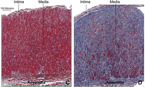 Medial Fibrosis Vascular Calcification Intimal Hyperplasia And Arteriovenous Fistula