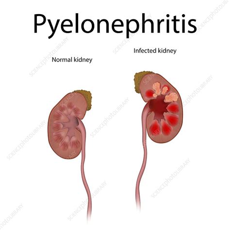 Pyelonephritis Illustration Stock Image F025 1355 Science Photo Library