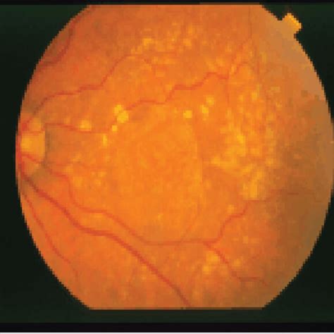 Work Flow Of Glaucoma Detection Download Scientific Diagram