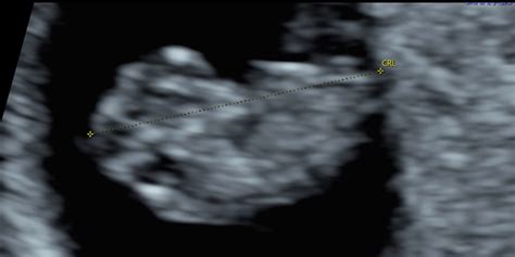 10 гестационна седмица от бременността