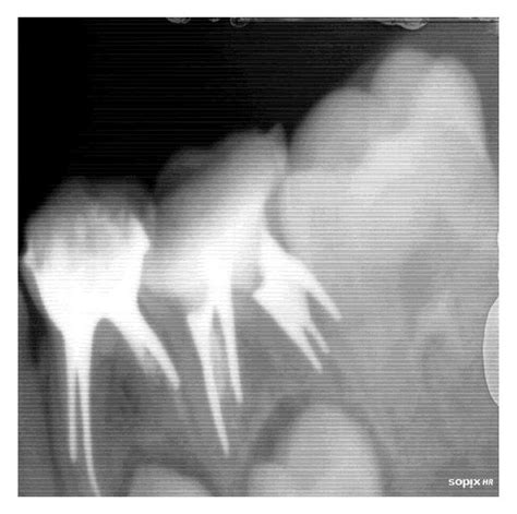 Canals Obturated With Metapex Paste In 74 And 75 Rvg Image Download Scientific Diagram