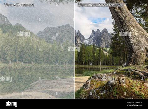 Cataract Vision Simulation