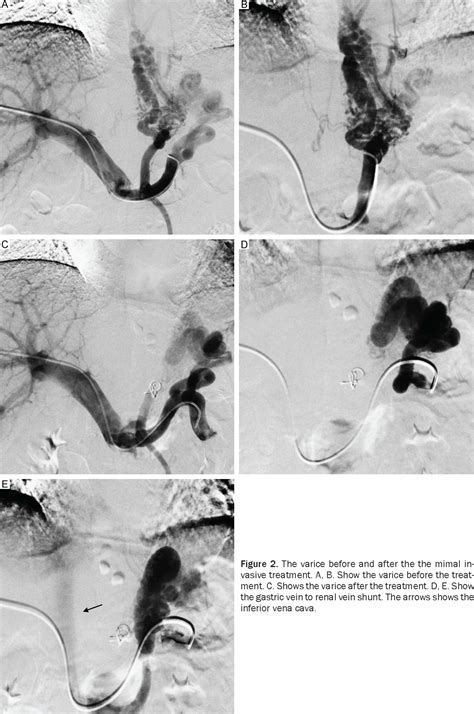 Figure 2 From Percutaneous Transhepatic Embolization Of