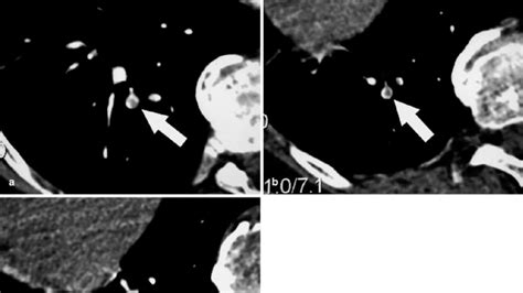 A C Segmental And Subsegmental Pulmonary Embolus In A 66 Year Old Woman Download Scientific