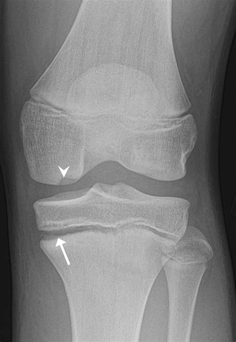 Growth Plate Fracture X Ray At Rachel Randall Blog