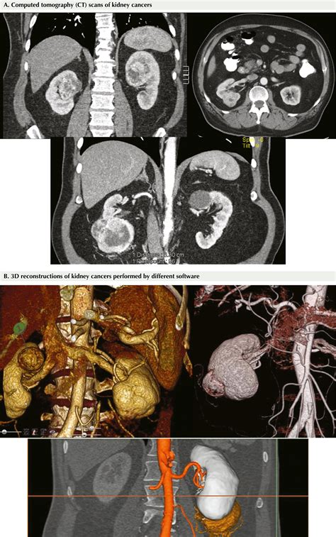Laparoscopic Transperitoneal Radical Nephrectomy Clinical Tree
