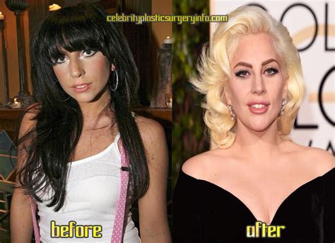 Lady Gaga Plastic Surgery 4 Most Popular Cosmetic Treatments In