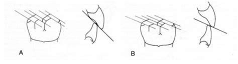Horizontal And Vertical Determinants Of Occlusion Flashcards Quizlet