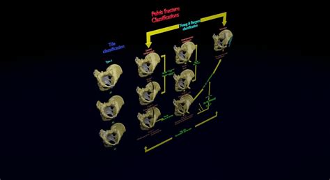 Pelvis Fracture Classifications 3d Model Superhive Formerly Blender Market