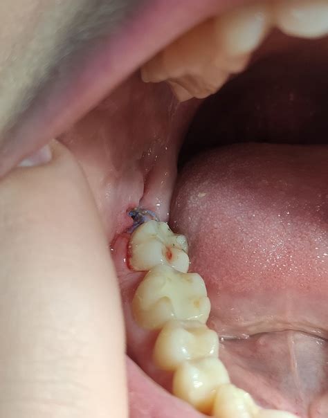 Подскажите пожалуйста после удаления 8 го зуба прошло 5 дней все время болит в особенности