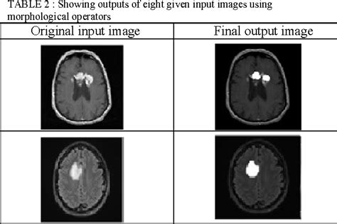 Table 2 From Detection Of Human Brain Tumour Using Mri Image Segmentation And Morphological