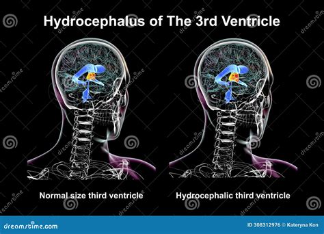 Enlargement Of The Third Brain Ventricle 3d Illustration