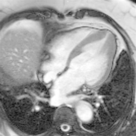Tissue Tracking Tool Application To Analyse Myocardial Strain In