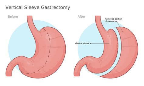 Partial Gastrectomy